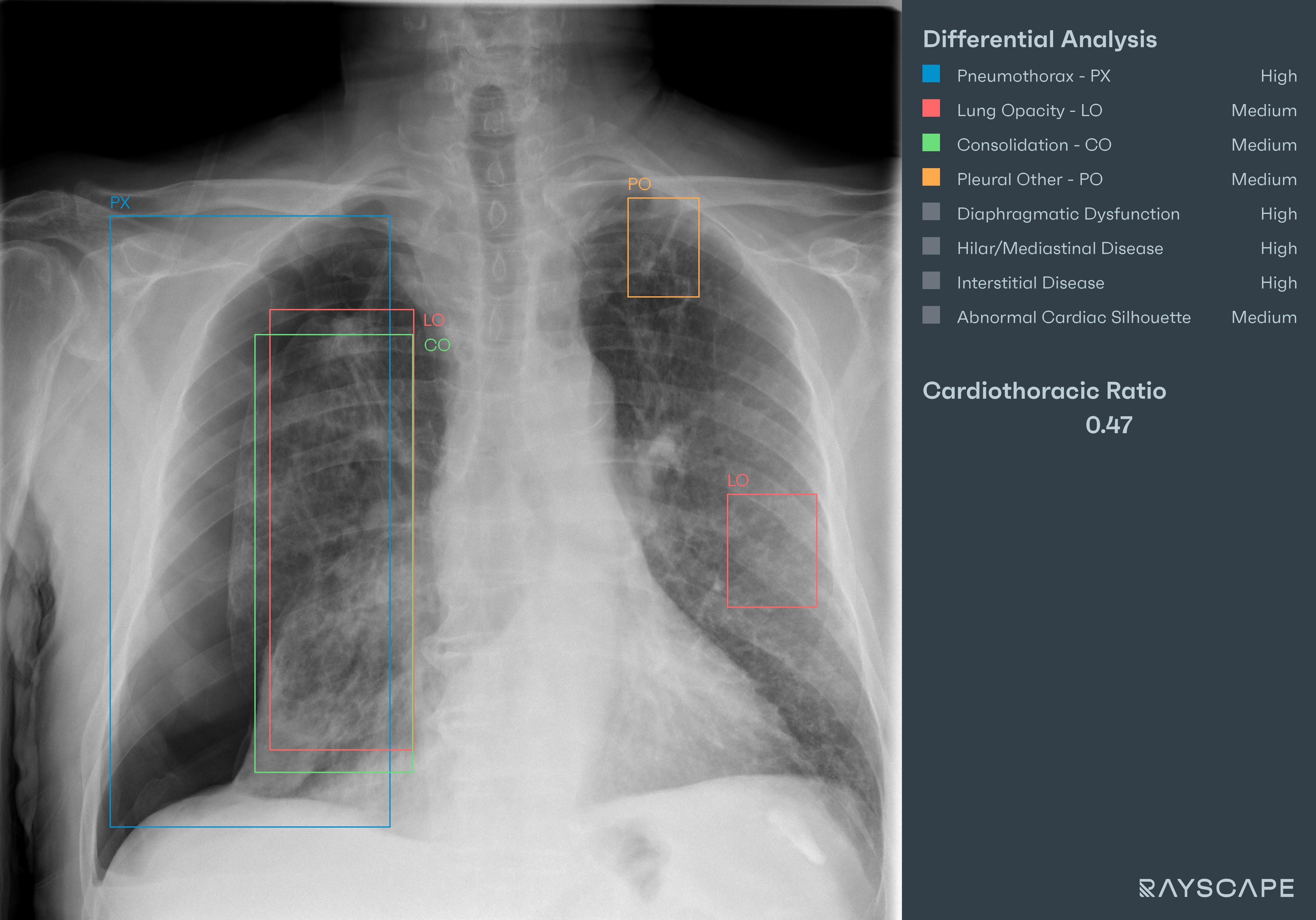 Lung Cancer Detection | Rayscape CXR
